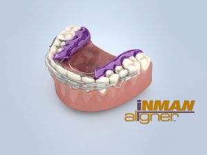 Inman Aligner – ST Mary’s House Dental Care